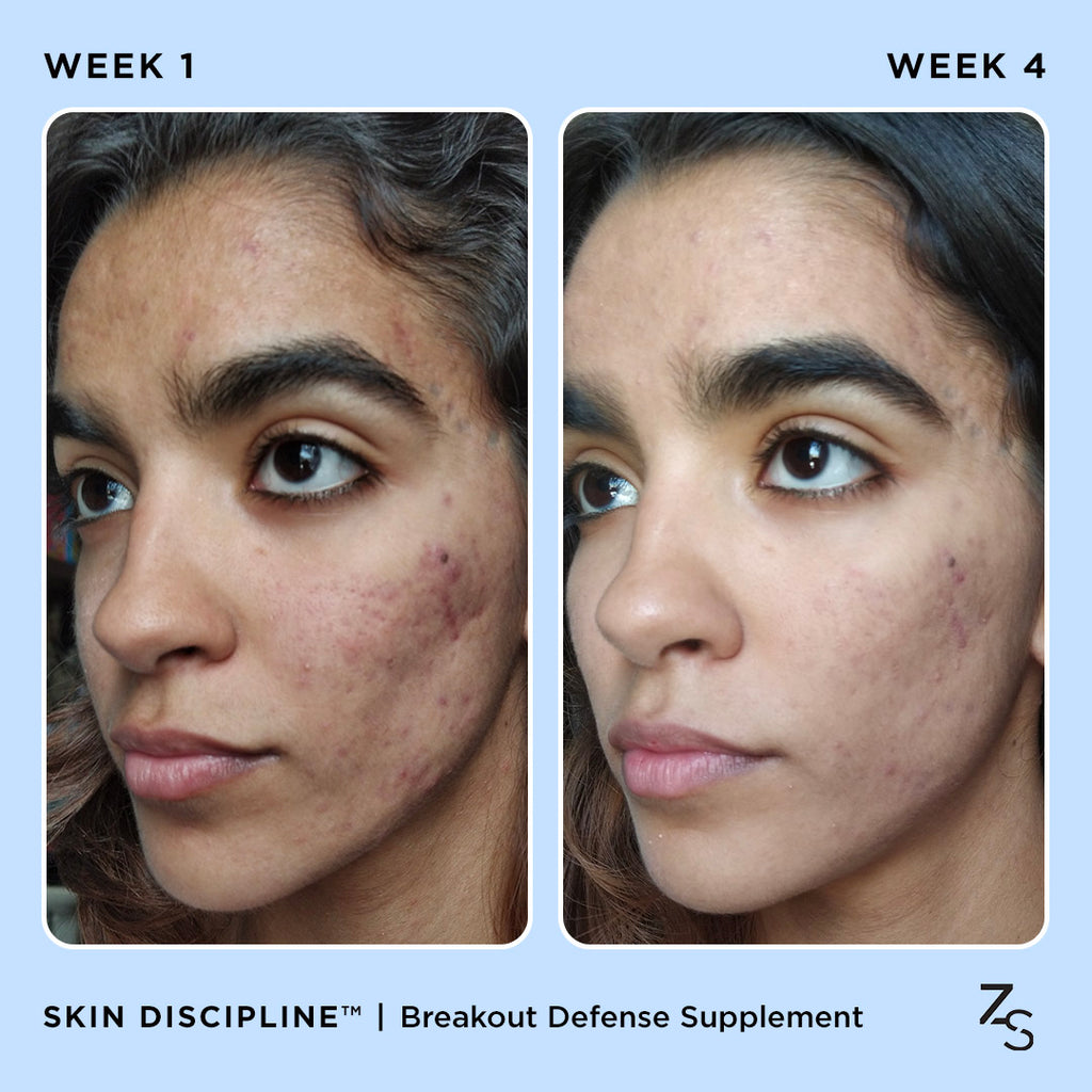 5 SKIN DISCIPLINE Devotees Share Their Supplement Journeys – ZitSticka UK