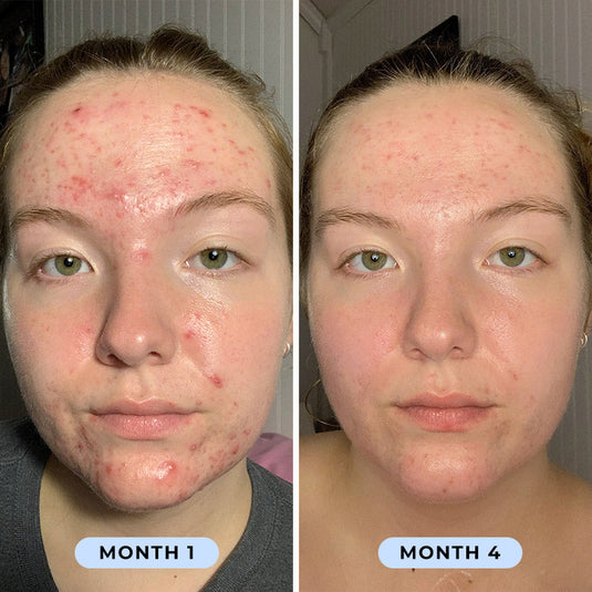 ZitSticka™ | Zit Treatment | Face Skincare | ZitSticka UK